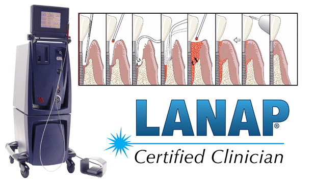 Laser Gum Surgery LANAP - Periodontal Treatment in West New York, NJ